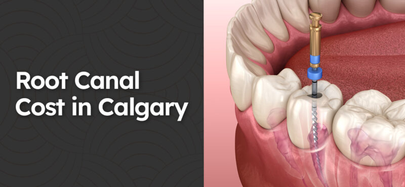 Root Canal Cost in Calgary | Sierra Dental