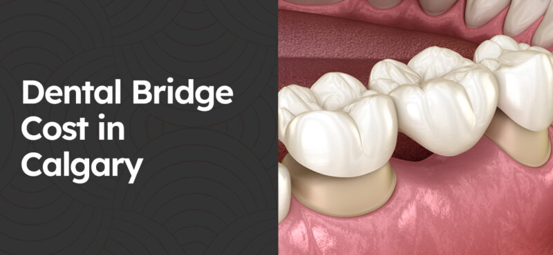 Dental Bridge Cost in Calgary | Sierra Dental