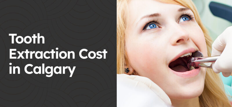 Tooth Extraction Cost in Calgary | Sierra Dental