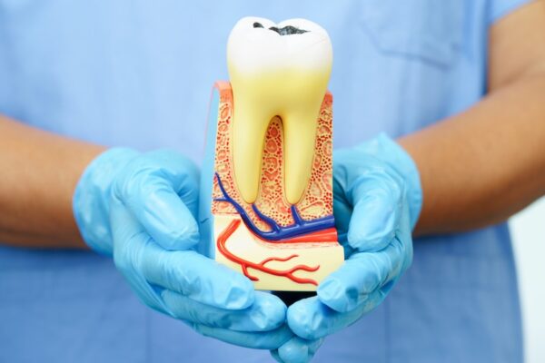 My Tooth Broke After a Root Canal — What Should I Do? | Sierra Dental