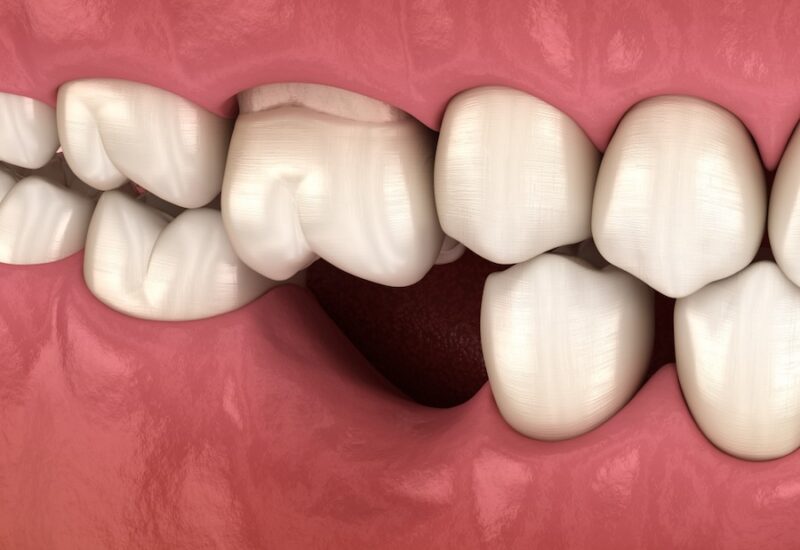 Understanding Single Tooth Bridges | Sierra Dental